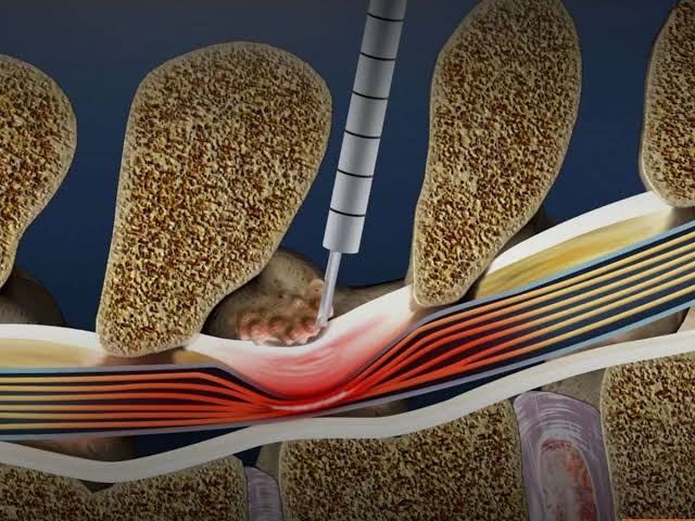 Mild Procedure For Lumbar Spinal Stenosis What You Need To Know Business To Mark